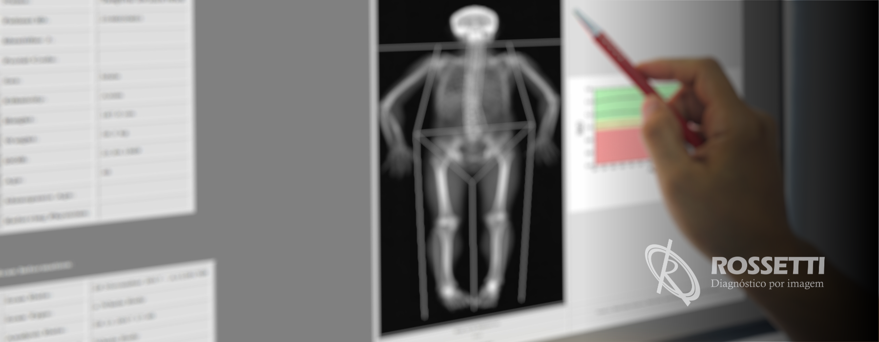 Densitometria deu ‘osteopenia’: o que significa o T-score | Clínica ...